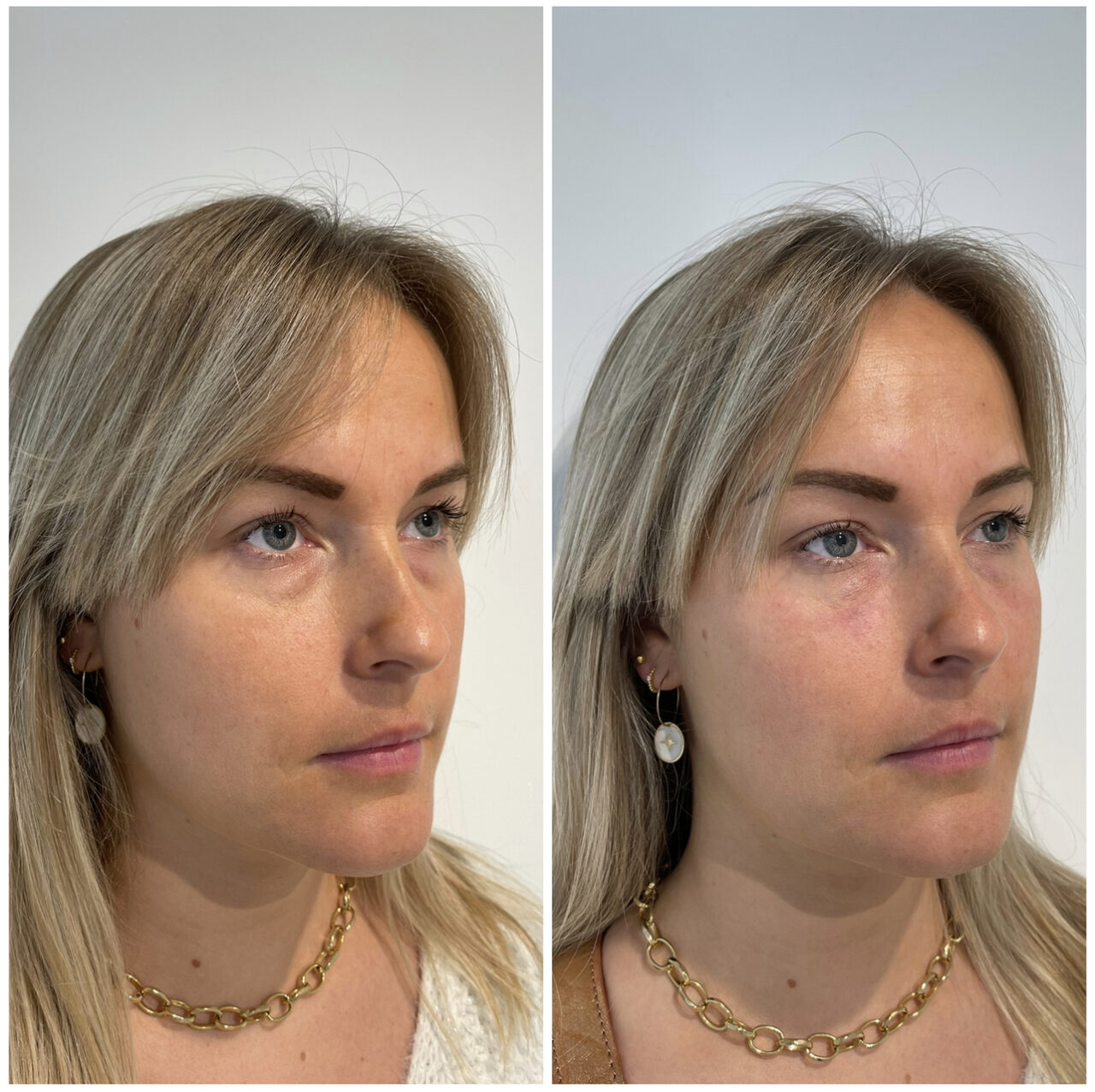 Voor & Na - The Enhance Clinic